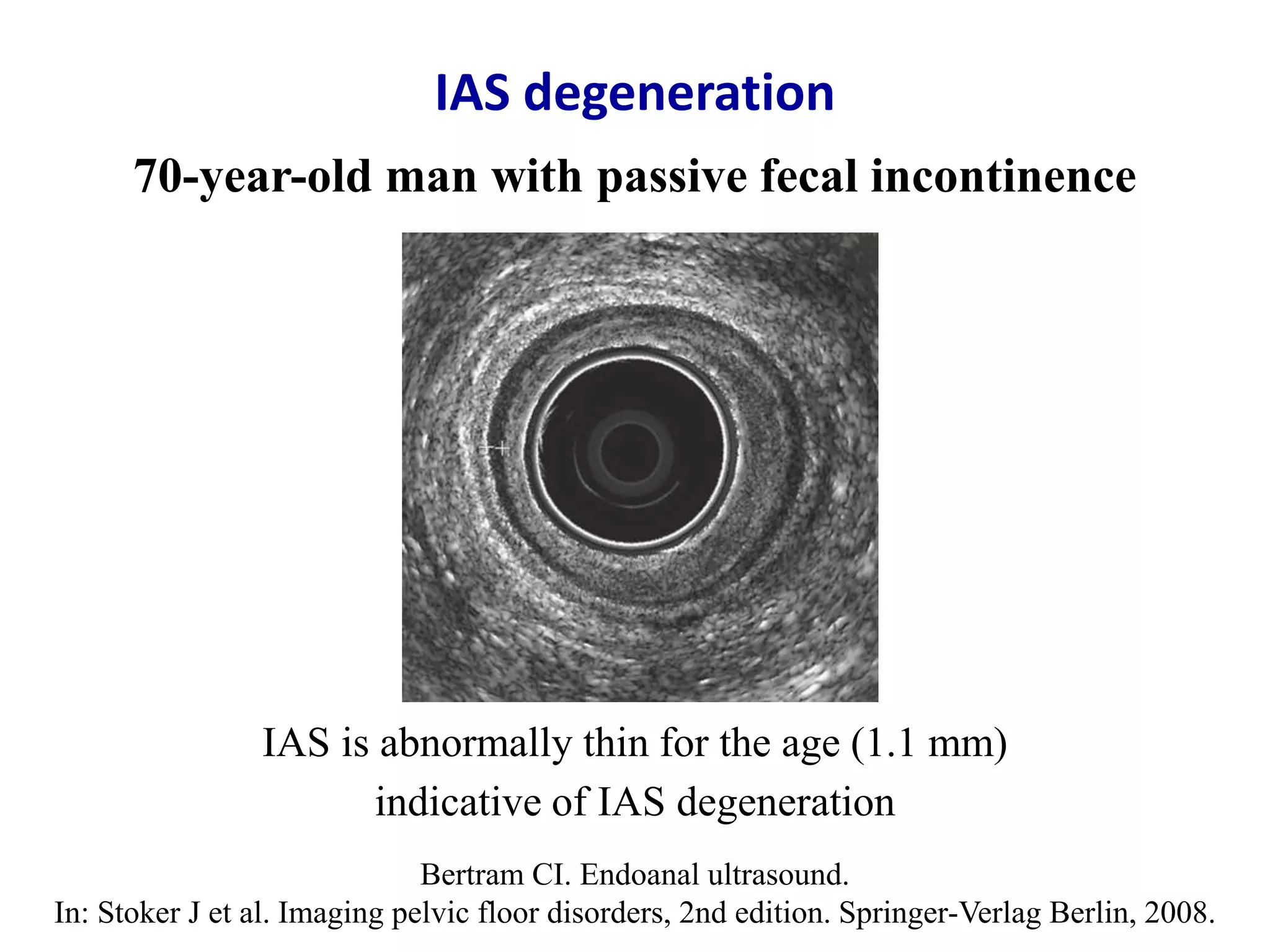 Endoanal ultrasound in anal diseases | PPTX