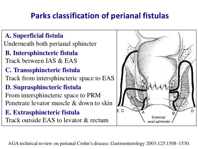 Anorectal Fistula Classification