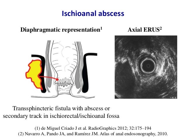 Endoanal ultrasound in anal diseases