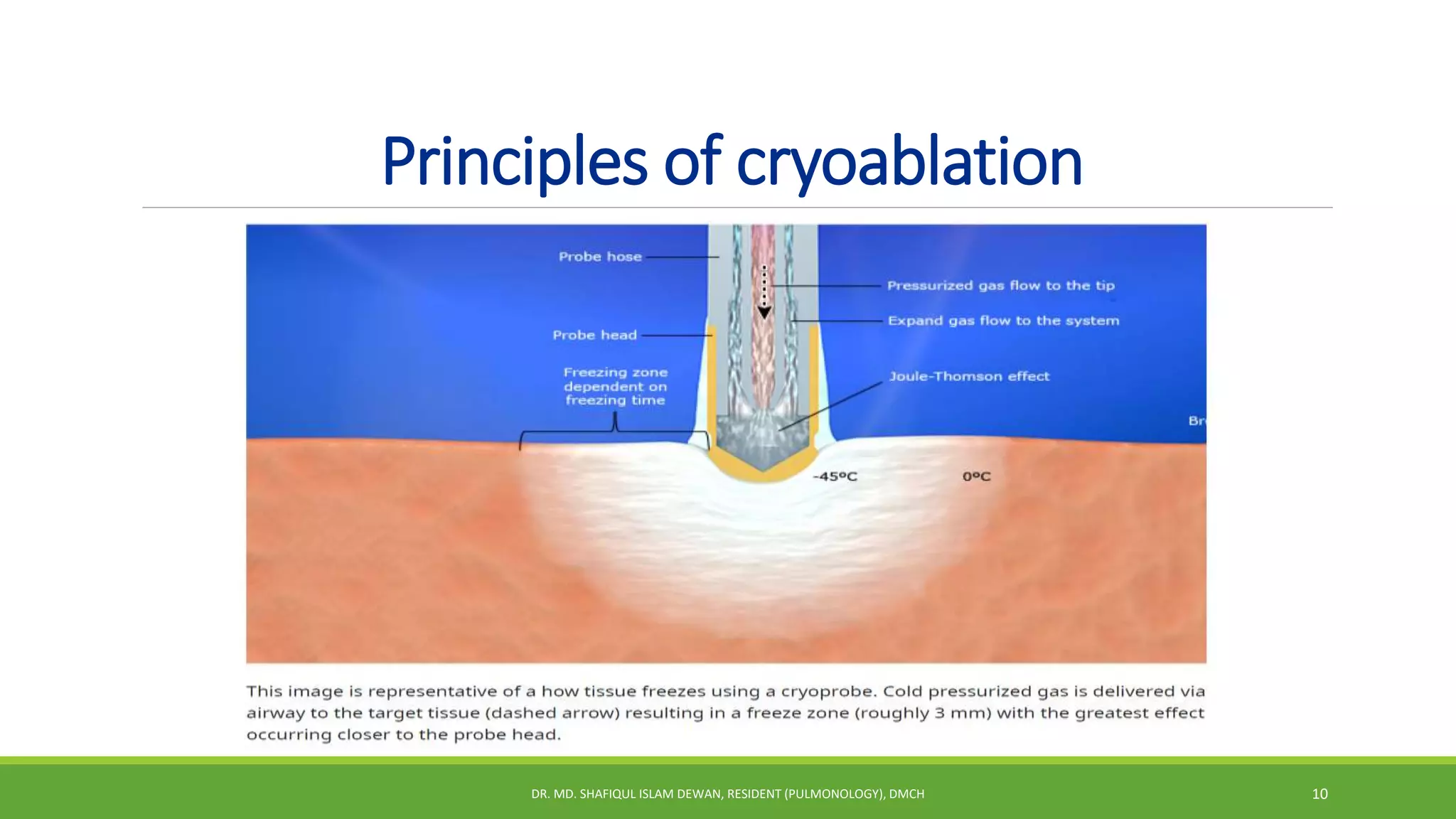Endobronchial Cryotherapy.pptx