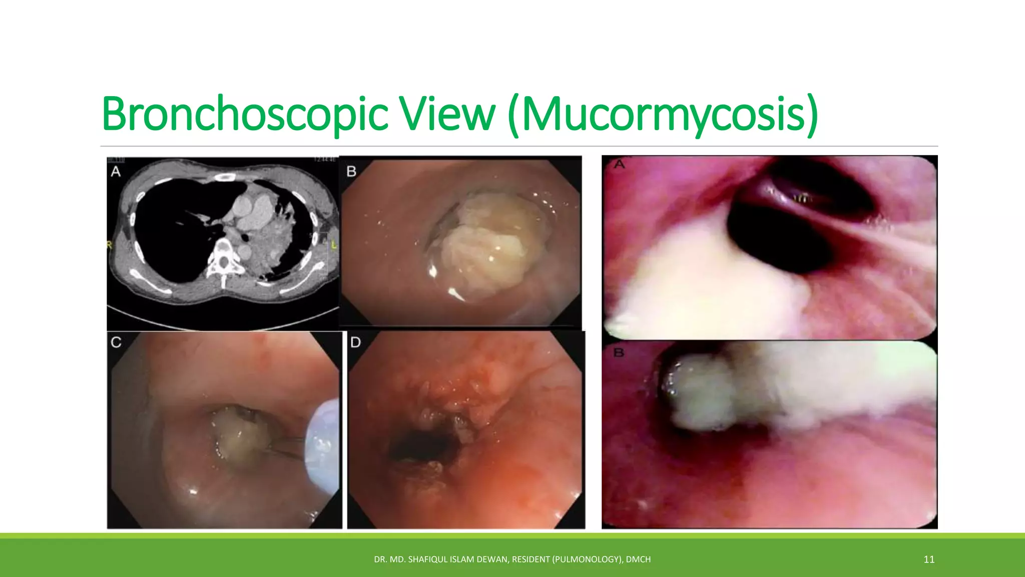Endobronchial fungal infection (EBFI).pptx
