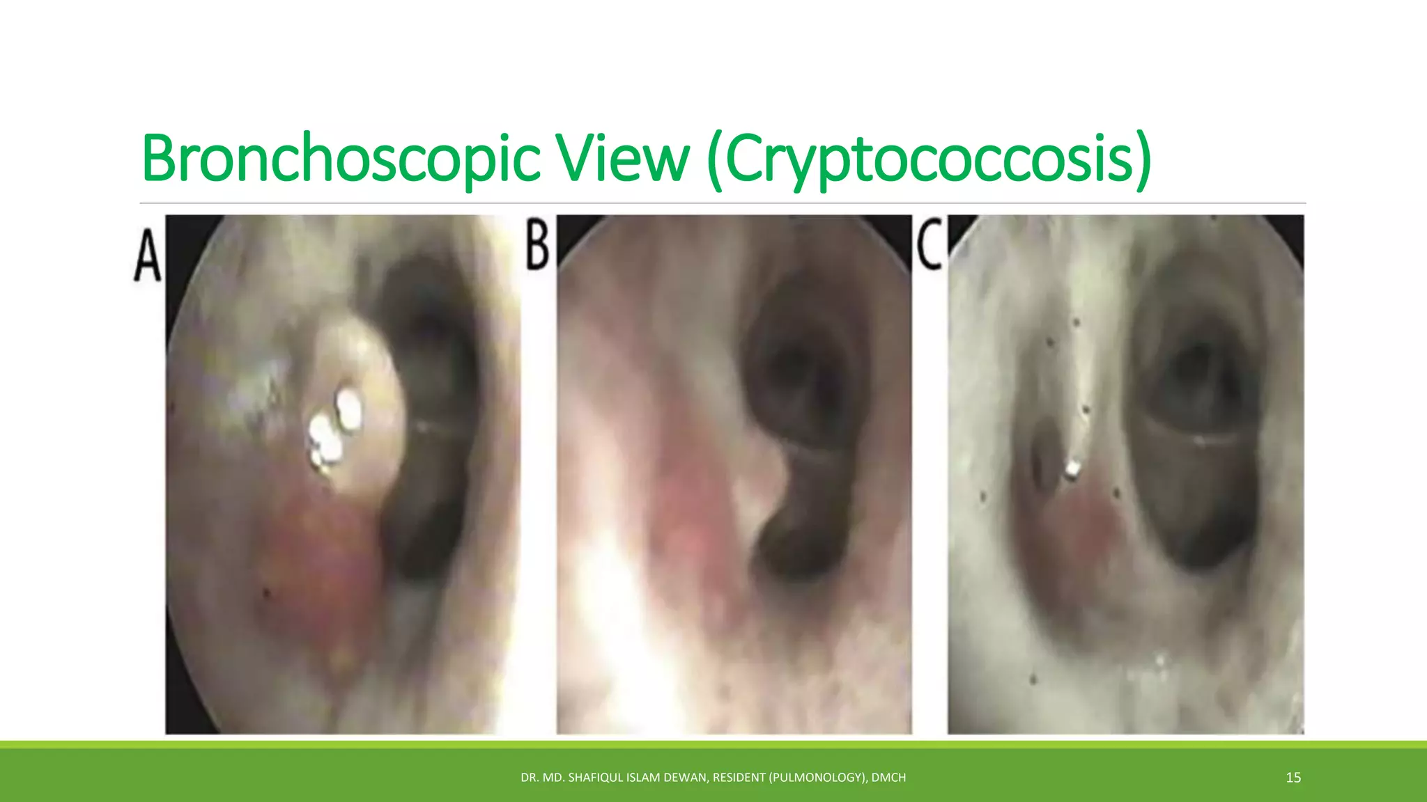 Endobronchial fungal infection (EBFI).pptx