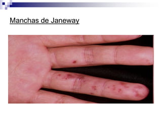 Endocardite infecciosa | PPT