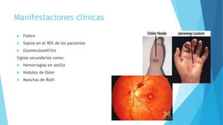 Endocarditis | PPT