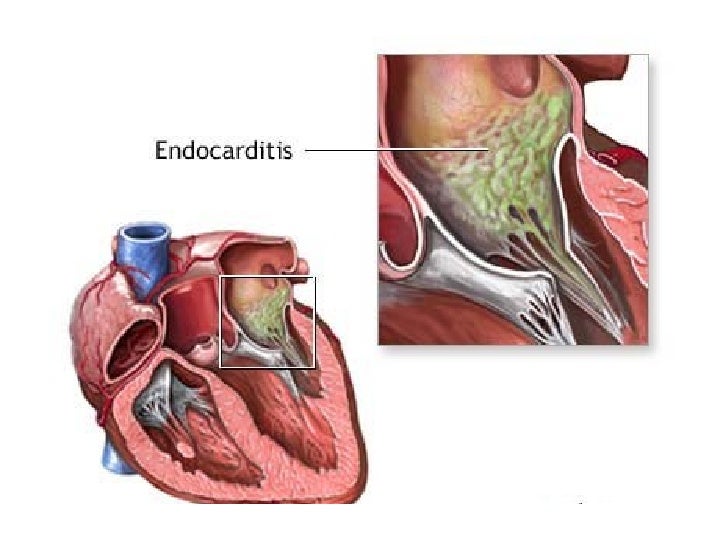 Endocarditis
