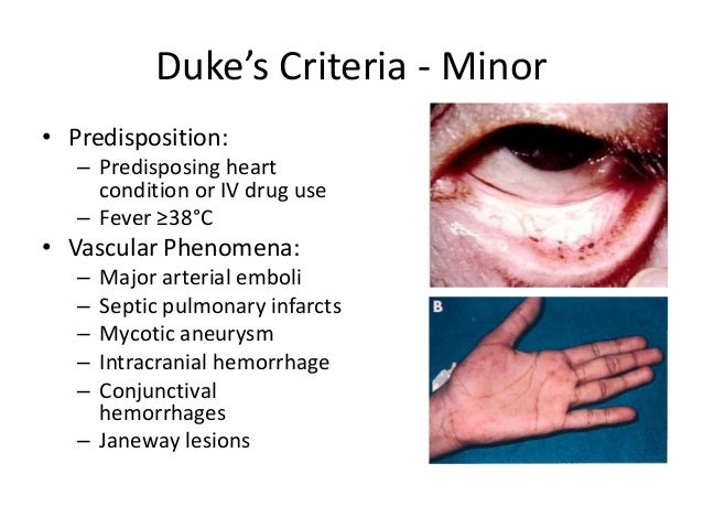 Infective Endocarditis and It's Surgical Management