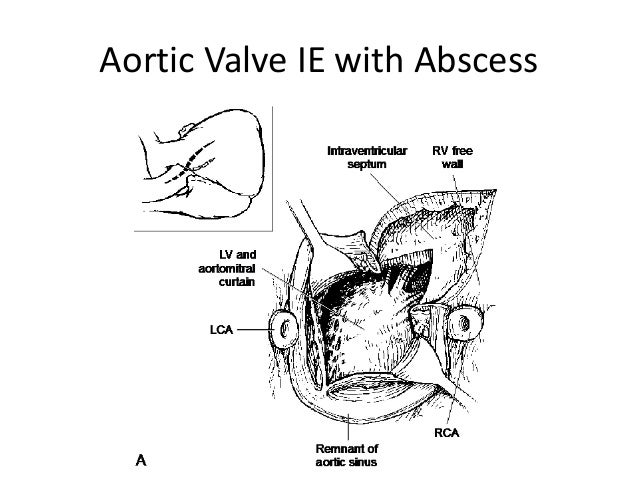 Infective Endocarditis and It's Surgical Management
