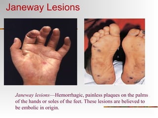 Endocarditis | PPT