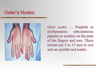 Endocarditis | PPT