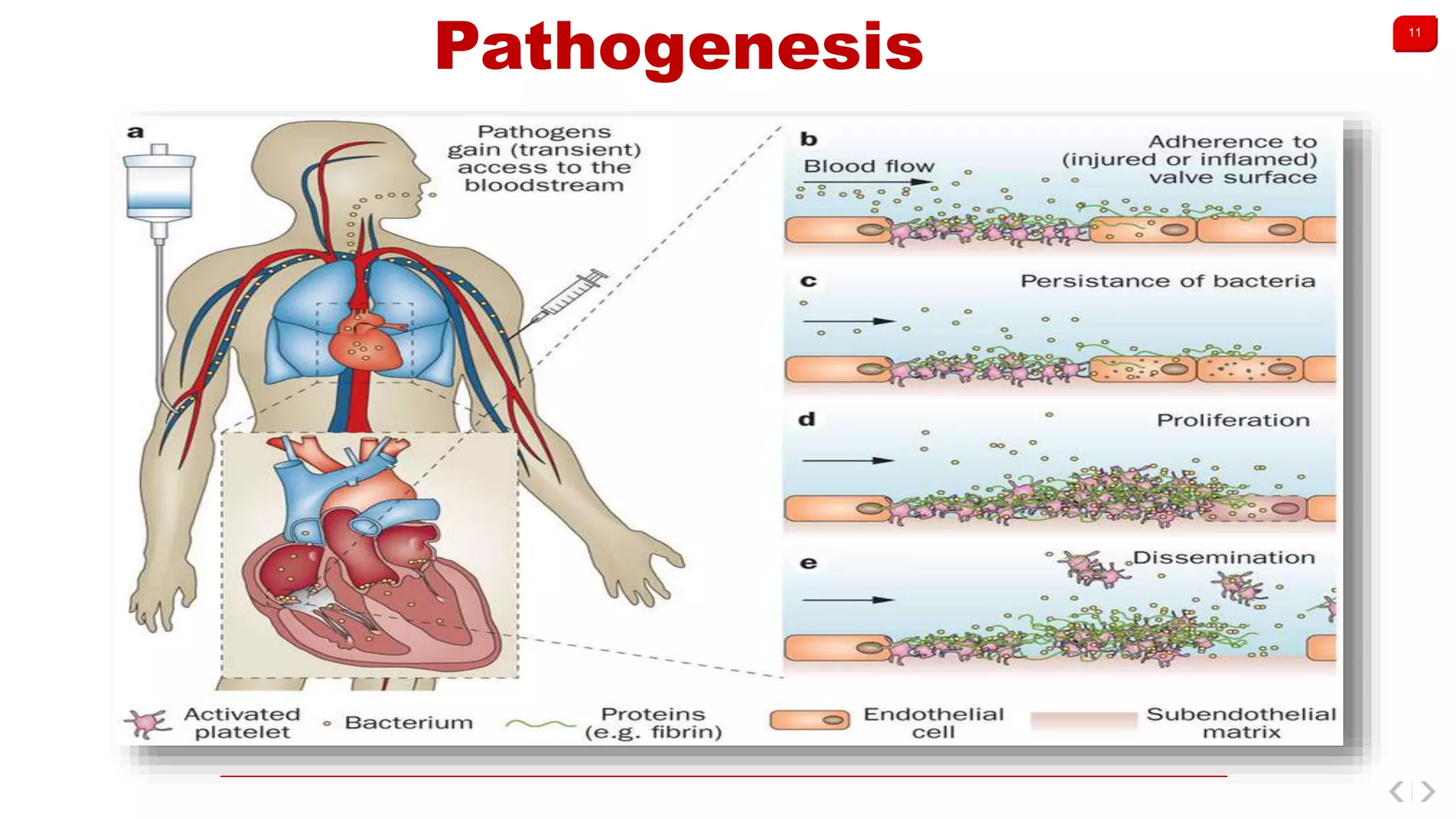 Infective Endocarditis | PPTX