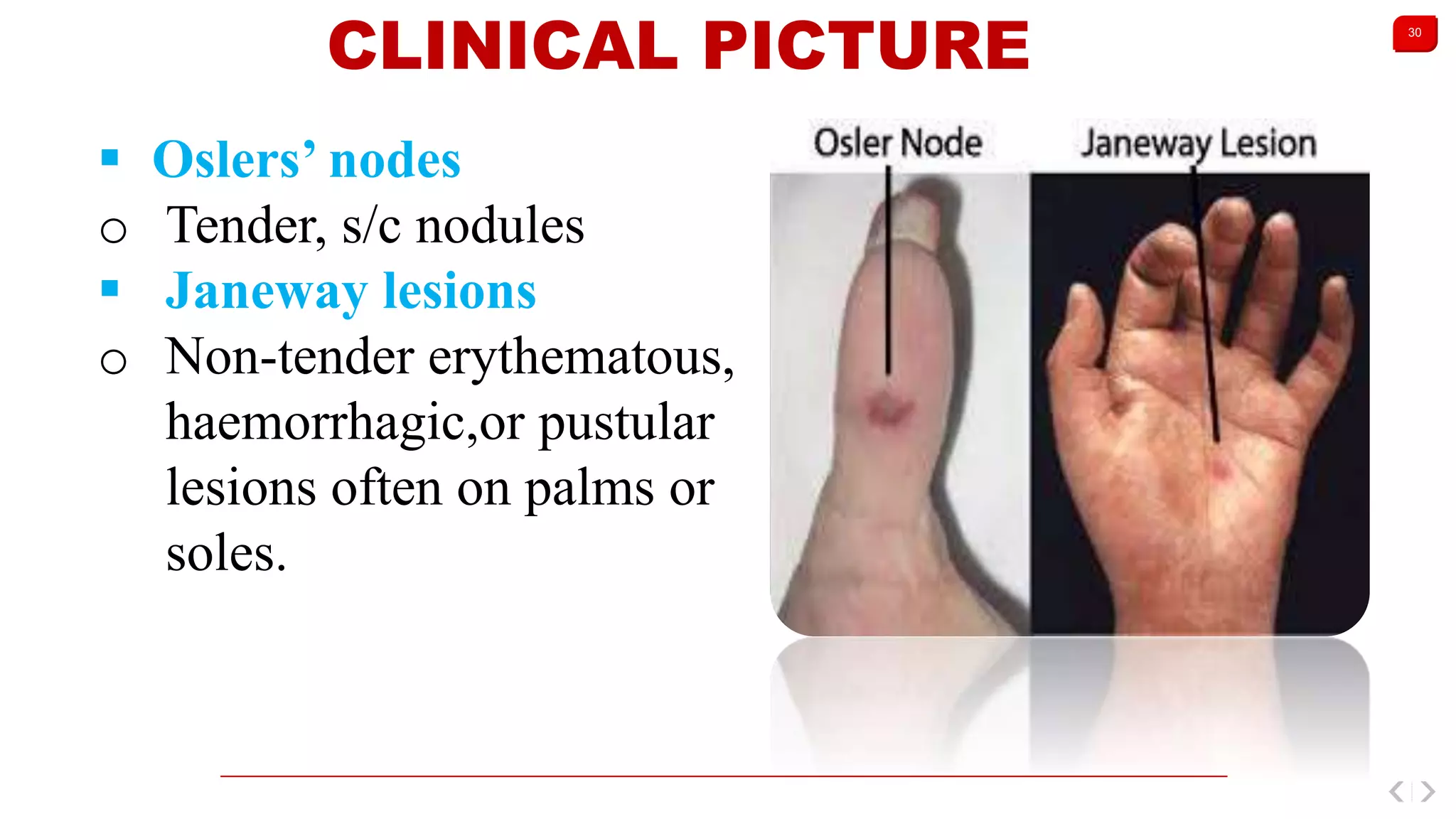Infective Endocarditis | PPTX