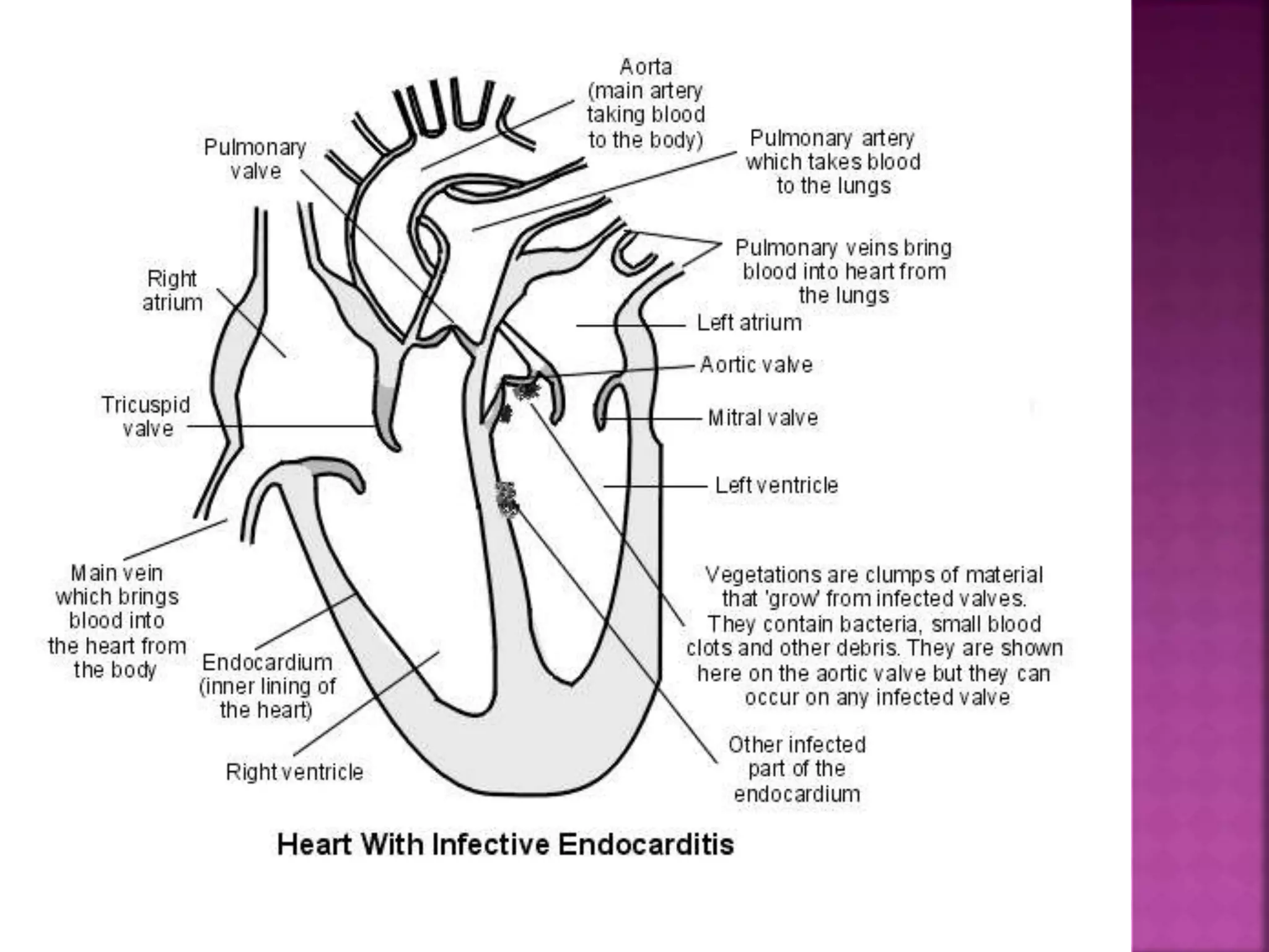 Endocarditis | PPTX