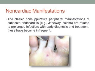 Endocarditis | PPTX