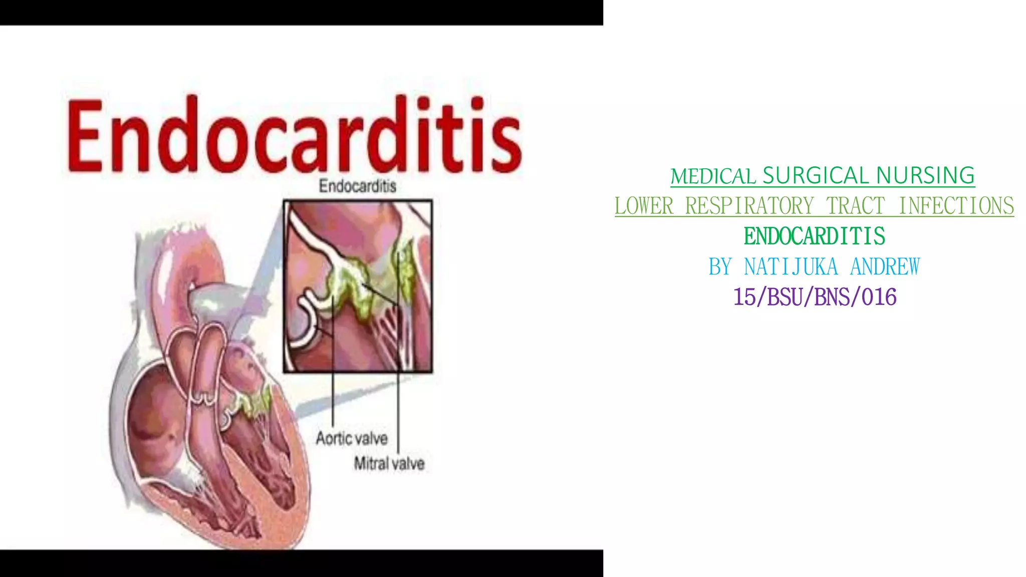 Endocarditis | PPTX