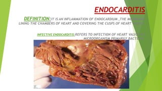 Endocarditis | PPTX