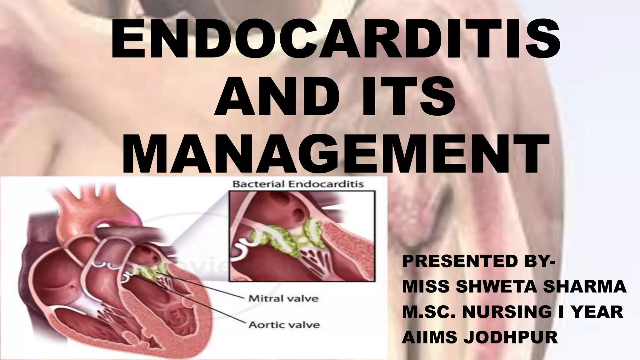 Endocarditis and its management | PPTX