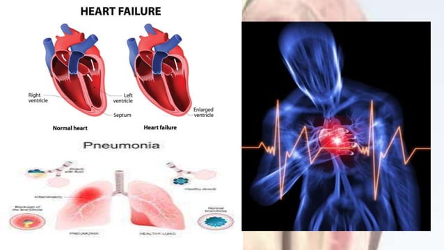 Endocarditis and its management | PPTX | Heart and Cardiovascular ...