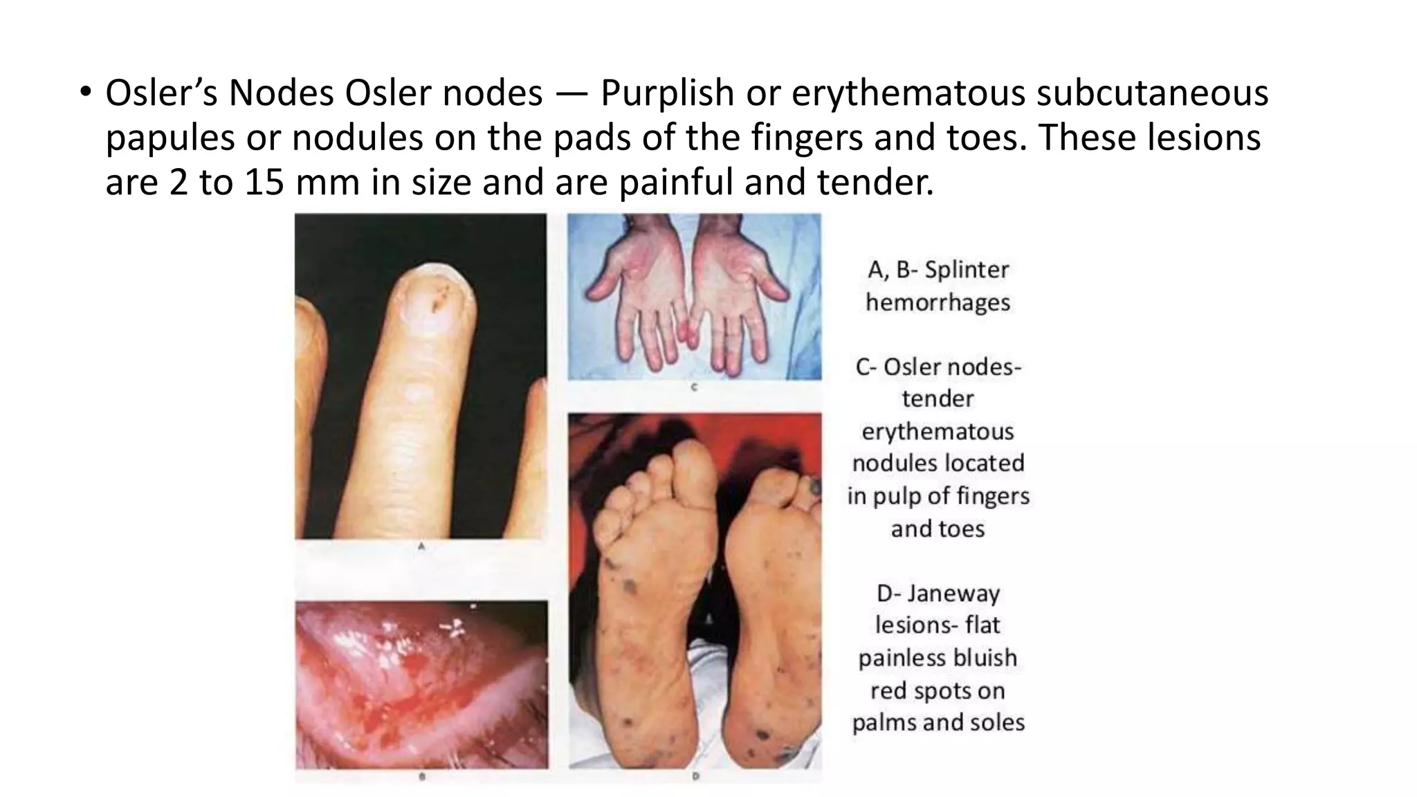 Endocarditis | PPTX