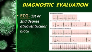 Endocarditis Ecg