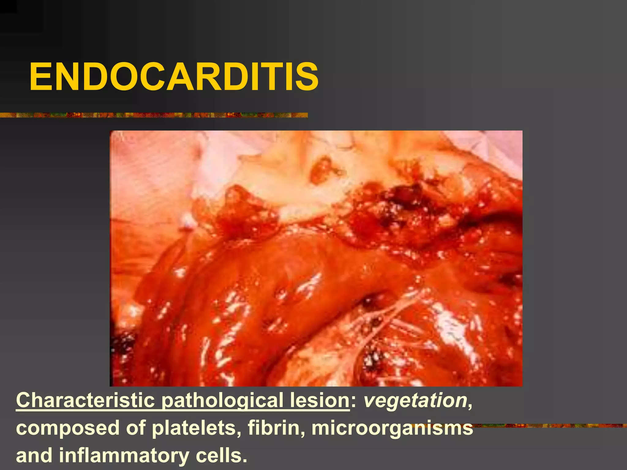 Endocarditis.ppt