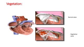 ENDOCARDITIS.pptx | Heart and Cardiovascular Diseases | Diseases and ...