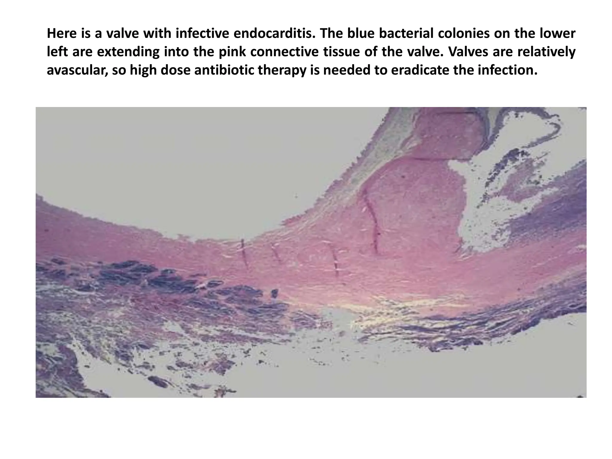 Infective Endocarditis (IE) Lecture pptx | PPTX