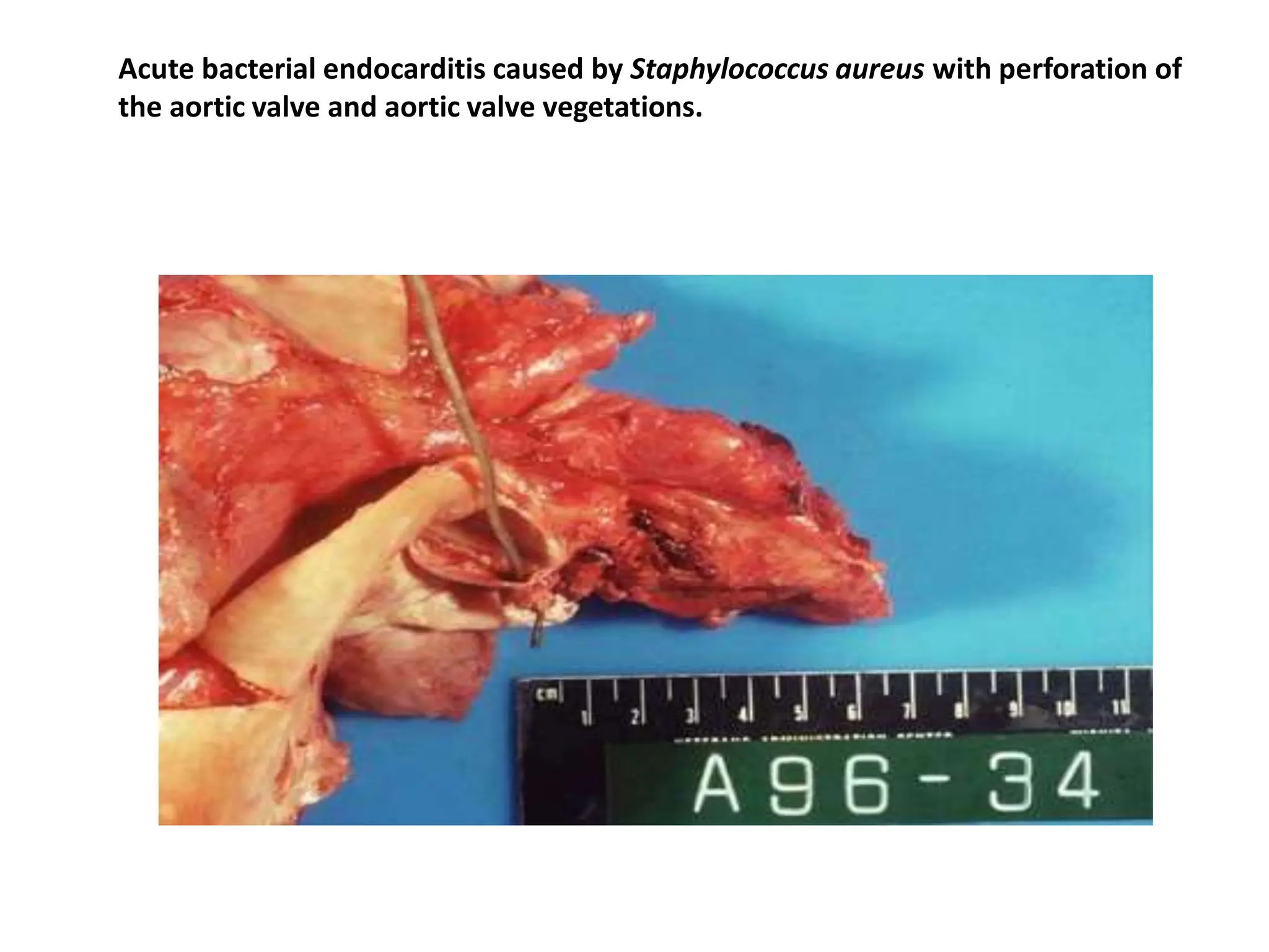 Infective Endocarditis (IE) Lecture pptx | PPTX