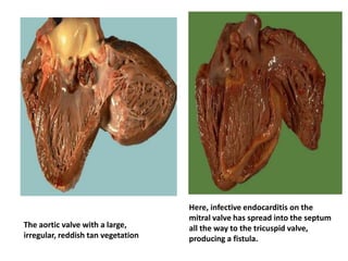 Infective Endocarditis (IE) Lecture pptx | PPTX