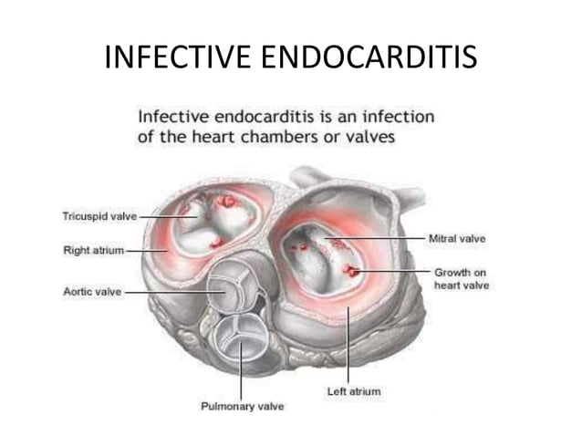 Infective Endocarditis (IE) Lecture pptx | PPTX | Heart and ...