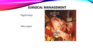Endocarditis-el.ppt