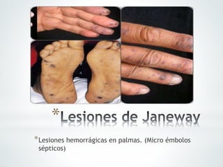 Endocarditis infecciosa | PPT