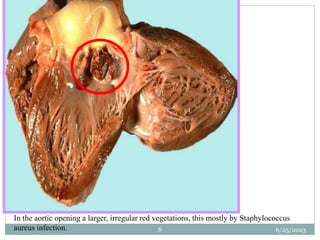 ENDOCARDITIS - lecture.pptx