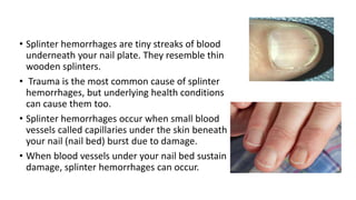 Endocarditis (1).pptx
