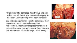 Endocarditis (1).pptx