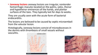 Endocarditis (1).pptx