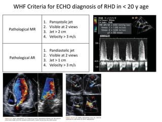 Endocarditis and rheumatic heart disease | PPTX