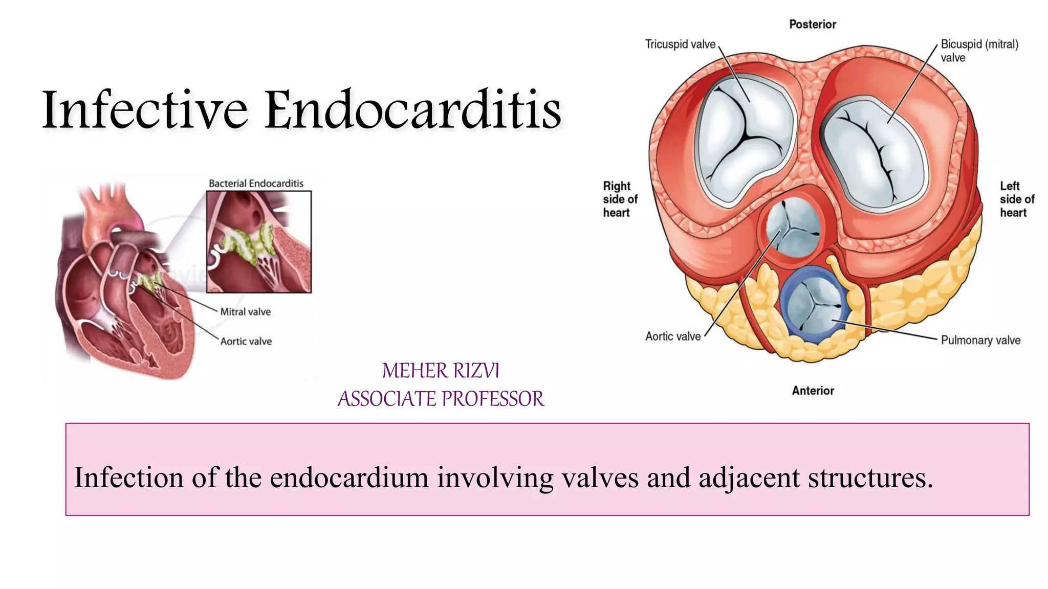 Endocarditis april 2018 | PPTX