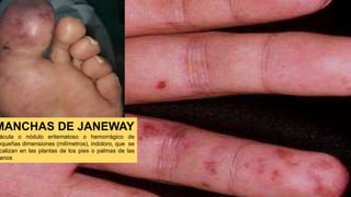 Endocarditis bacteriana a válvula nativa. | PPTX