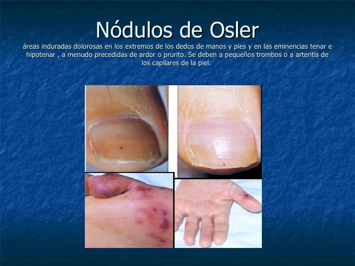 Endocarditis bacteriana diapos