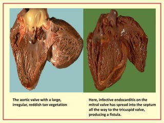 Endocarditis by maha | PPTX