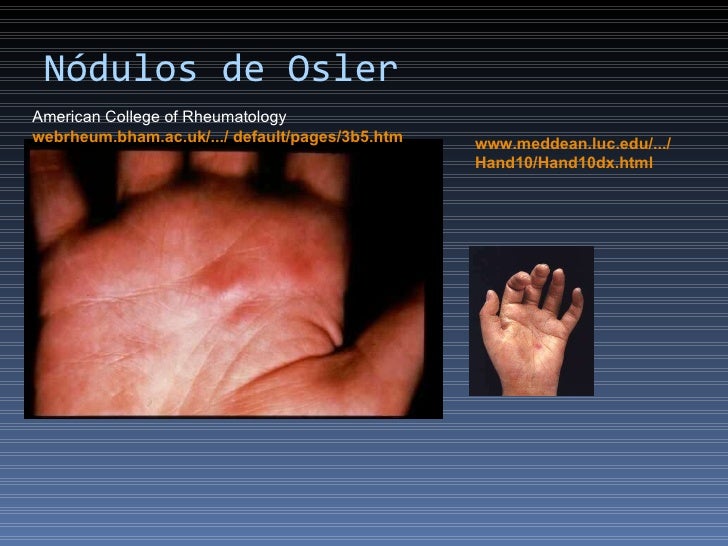 Endocarditis