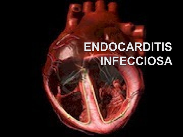 Endocarditis infecciosa