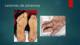 Endocarditis infecciosa | PPTX