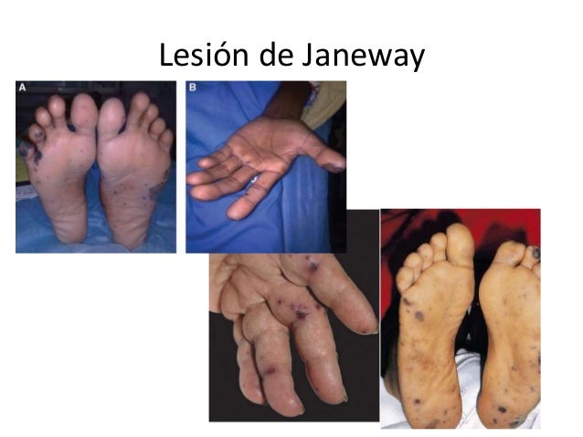 Endocarditis infecciosa