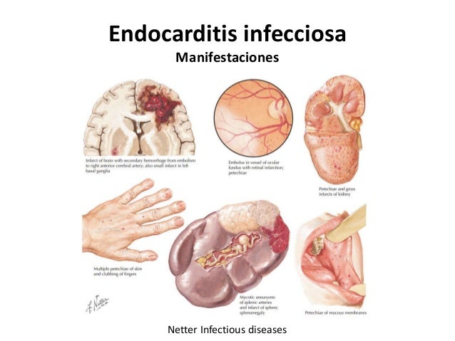 Endocarditis infecciosa