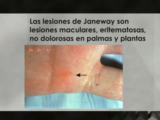 Endocarditis infecciosa | PPTX