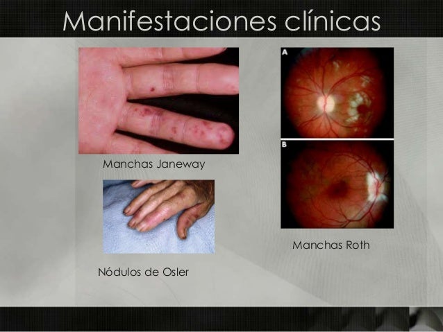 Endocarditis infecciosa