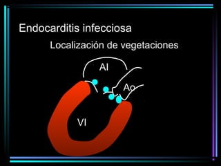 Endocarditis infecciosa | PPT