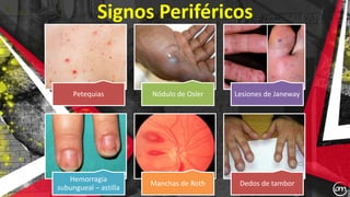 Endocarditis infecciosa | PPT