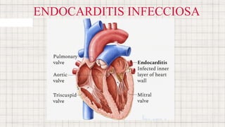 endocarditis infecciosa medica endocarditis | PPTX